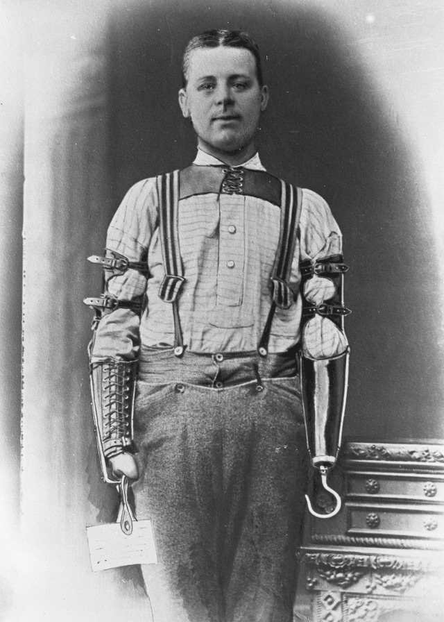 These Ingenious prostheses From 19th century helped 15,000 People ...