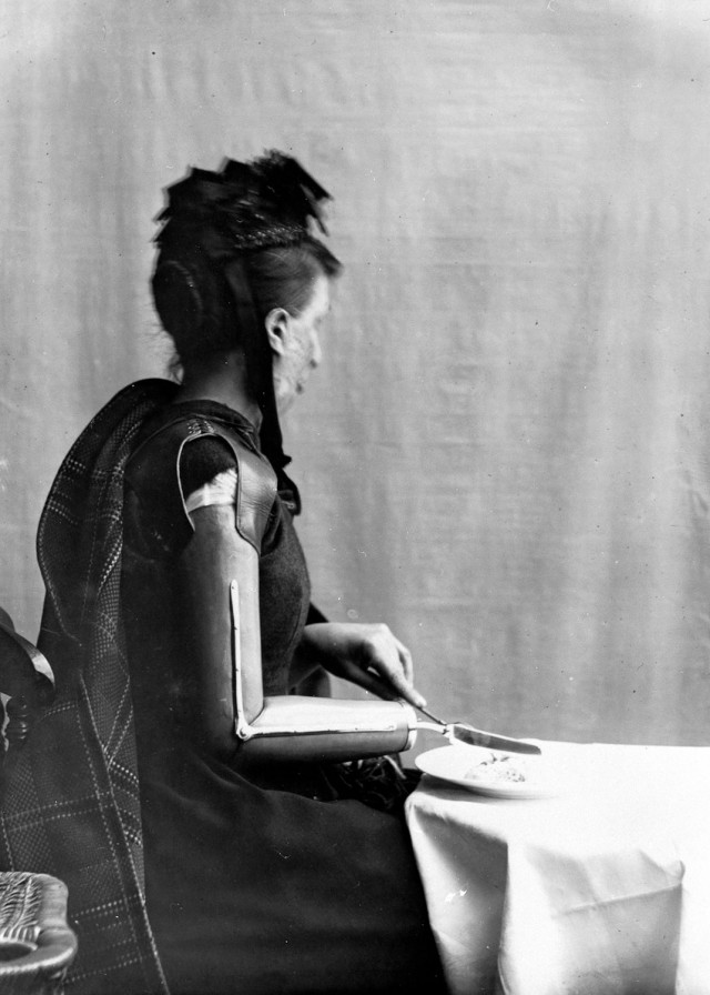 These Ingenious prostheses From 19th century helped 15,000 People ...